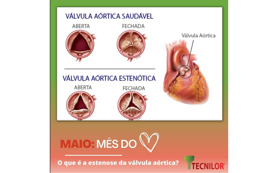 Estenose Aórtica - Tecnilor